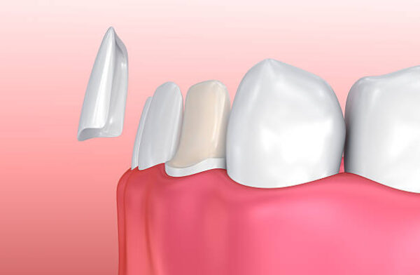 Veneers vs Implants, Bonding, Lumineers, Crowns, and Caps